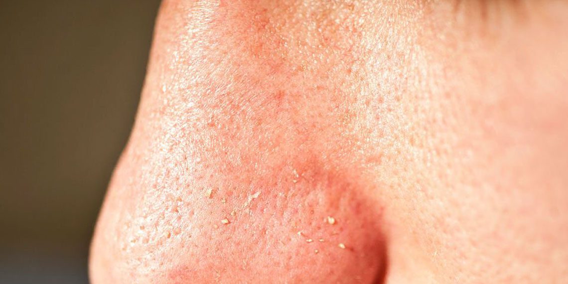 4 Different Types of Acne and How to Treat Them - Just Health Life